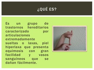Síndrome de hiperlaxitud articular | PPTX