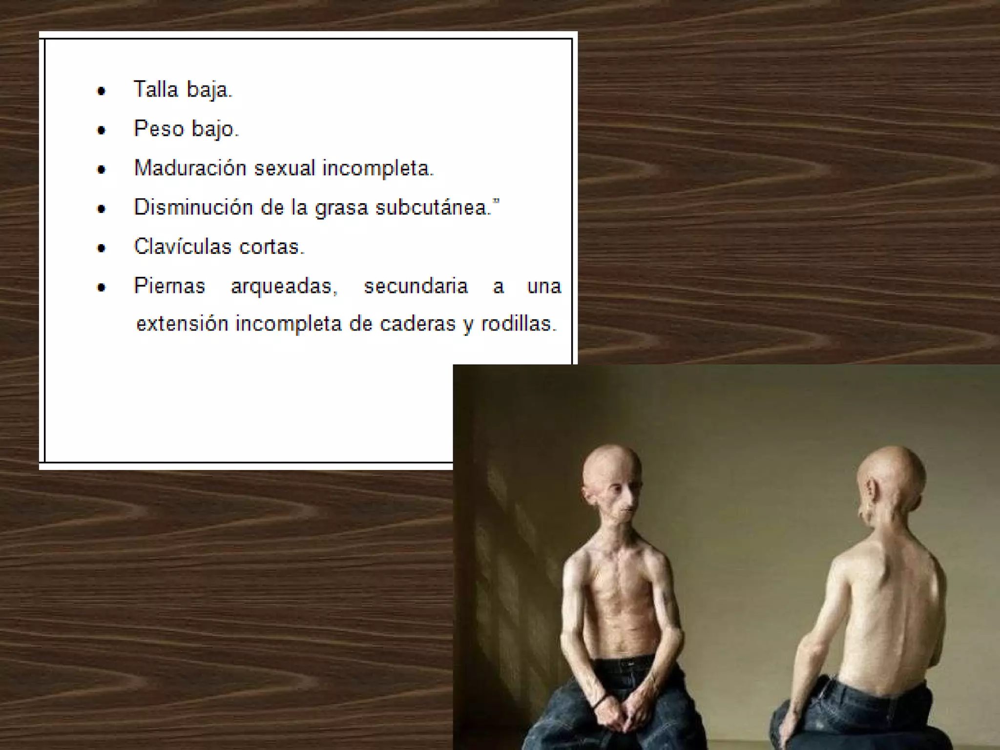 Síndrome de hutchinson Gilford, Progeria | PPT