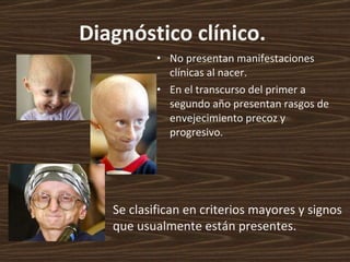 Síndrome de hutchinson Gilford, Progeria | PPT