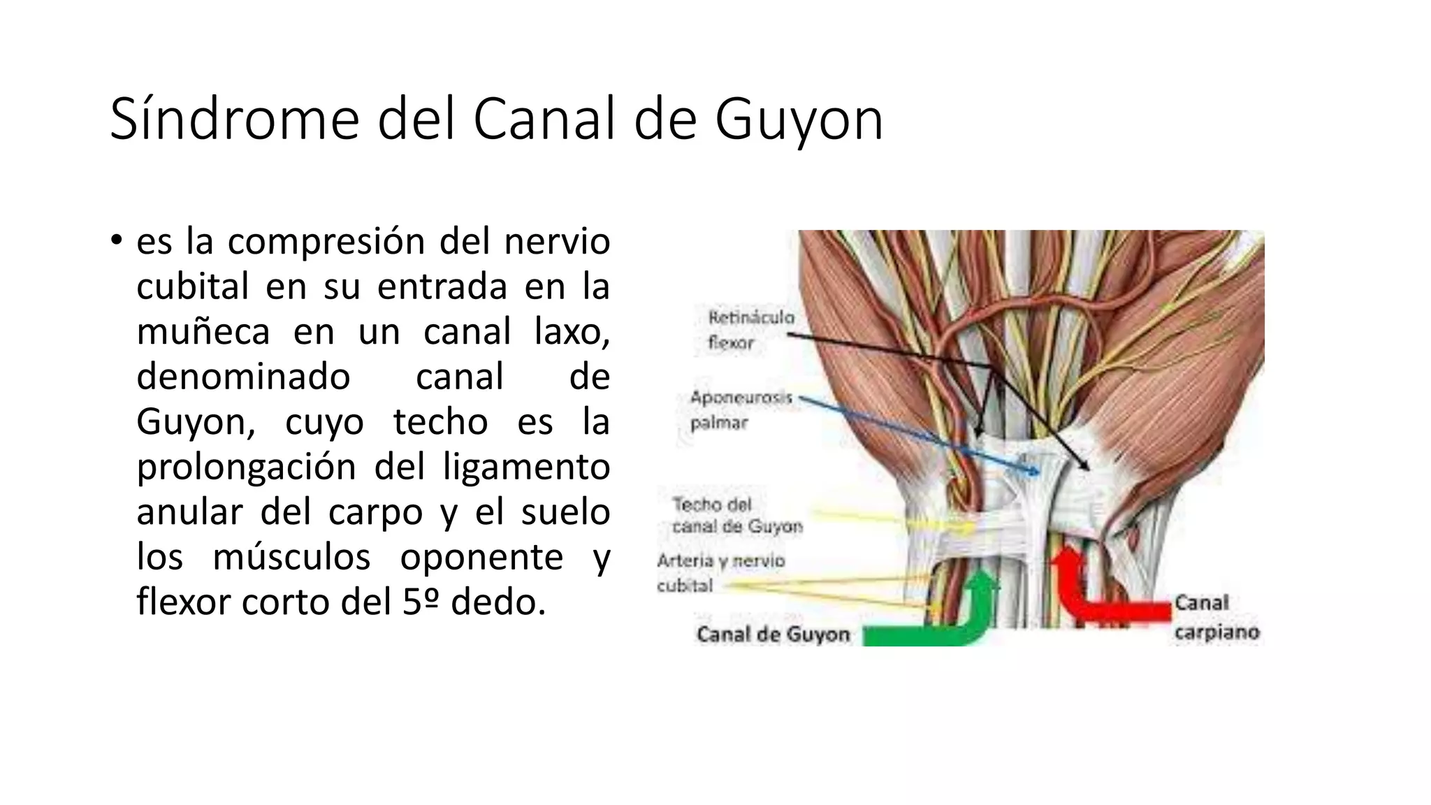 Síndrome del canal de guyon (1) | PPTX