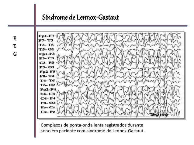 Síndrome de lennox gastaut