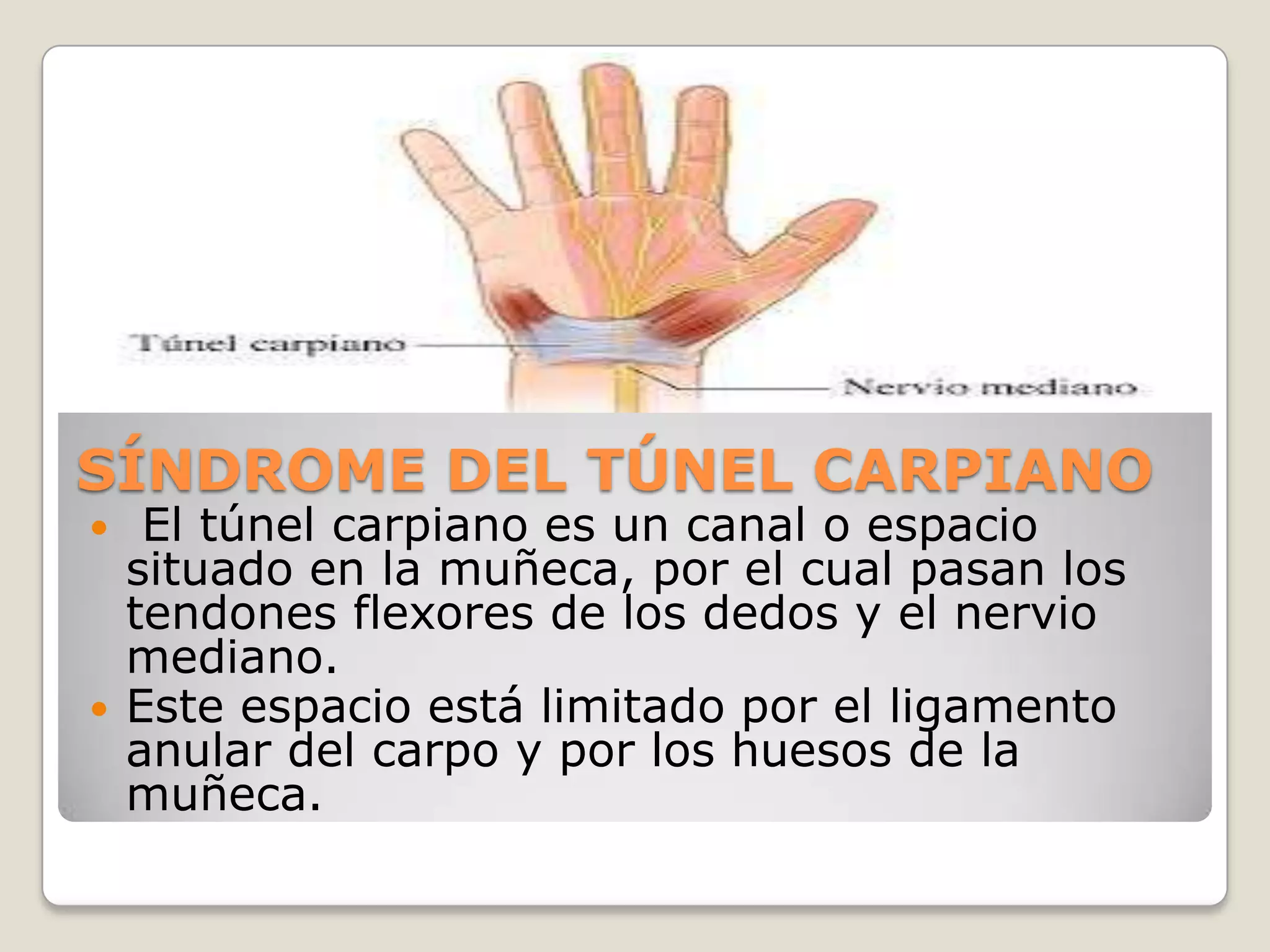 Síndrome del túnel carpiano | PPTX