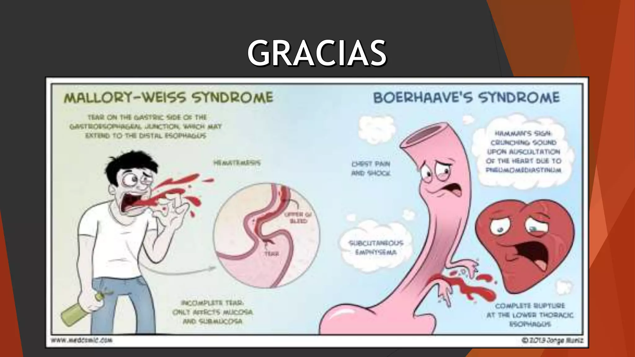 Síndrome de mallory weiss | PPTX | Digestive Disorders | Diseases and ...