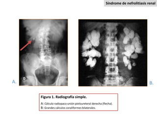 Síndrome de nefrolitiasis renal
