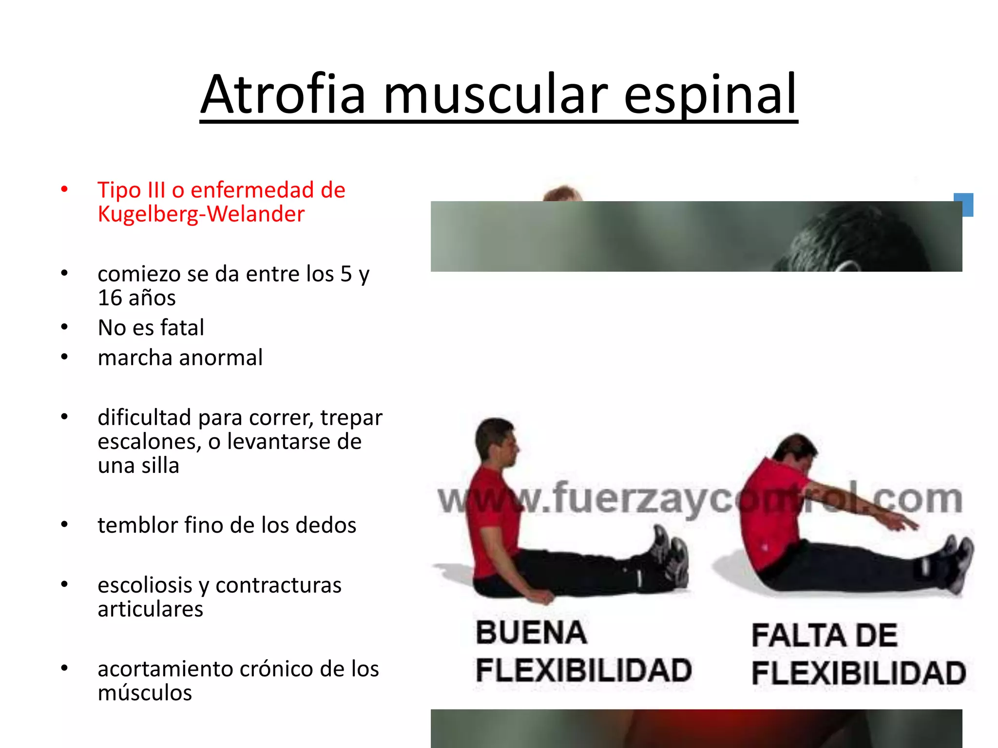 Síndrome de neurona motora superior e inferior | PPT