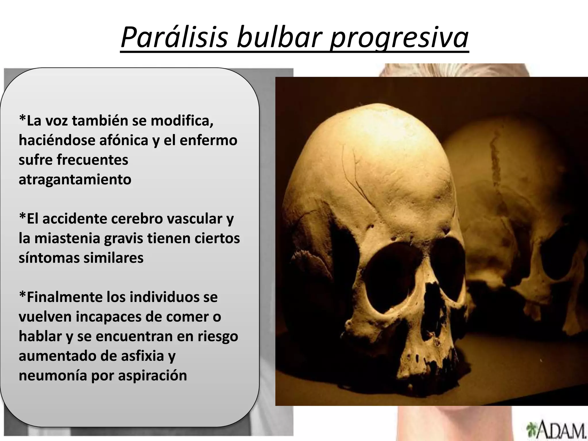Síndrome de neurona motora superior e inferior | PPTX