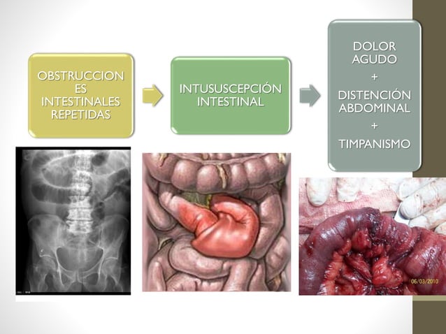 Síndrome de obstrucción intestinal | PPTX