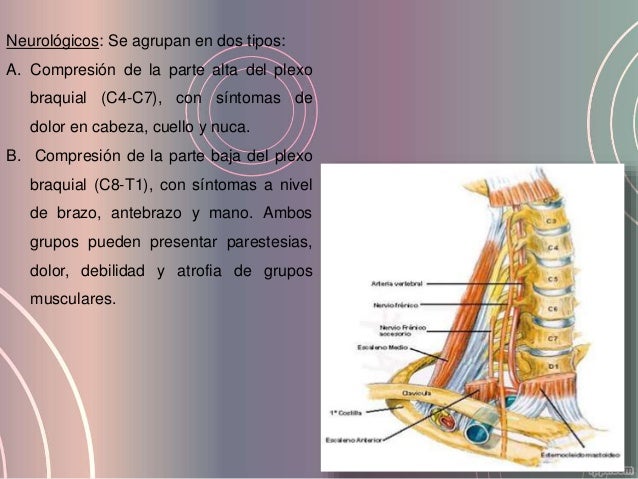 Síndrome de opérculo torácico y tratamiento en terapia ocupacional