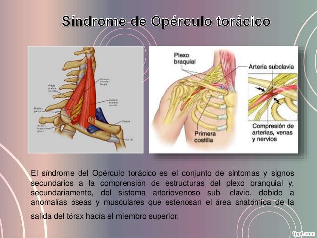 Síndrome de opérculo torácico y tratamiento en terapia ocupacional