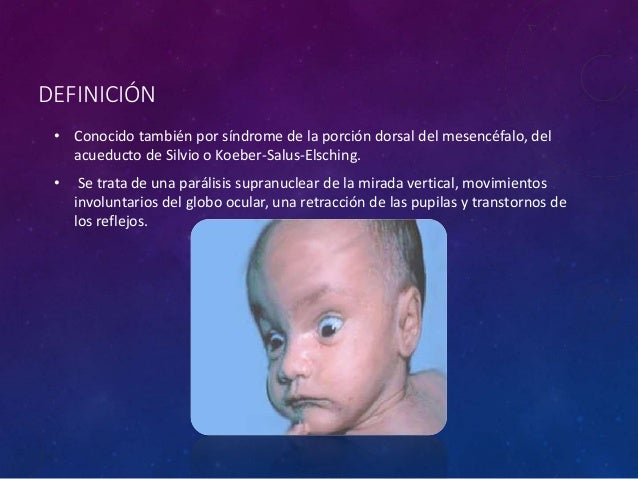 Síndrome de Parinaud