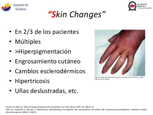 Síndrome de Poems: Caso Clínico