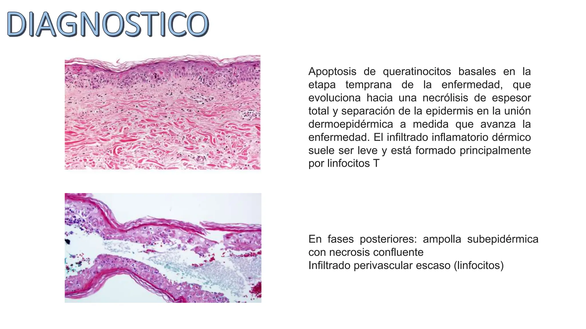 Síndrome de Stevens-Johnson y Necrólisis Epidérmica Tóxica.pptx