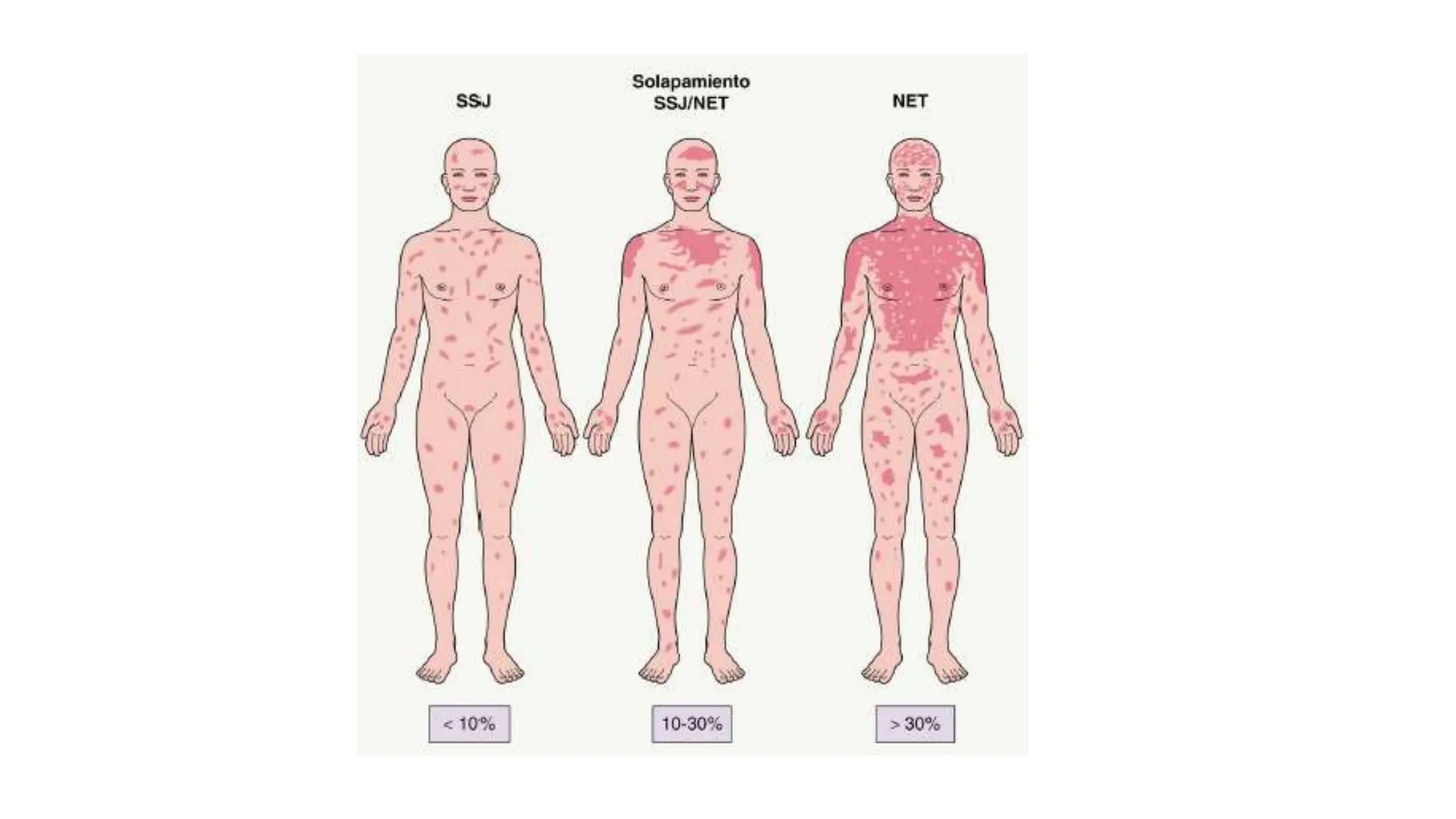 Síndrome de Stevens-Johnson y Necrólisis Epidérmica Tóxica.pptx