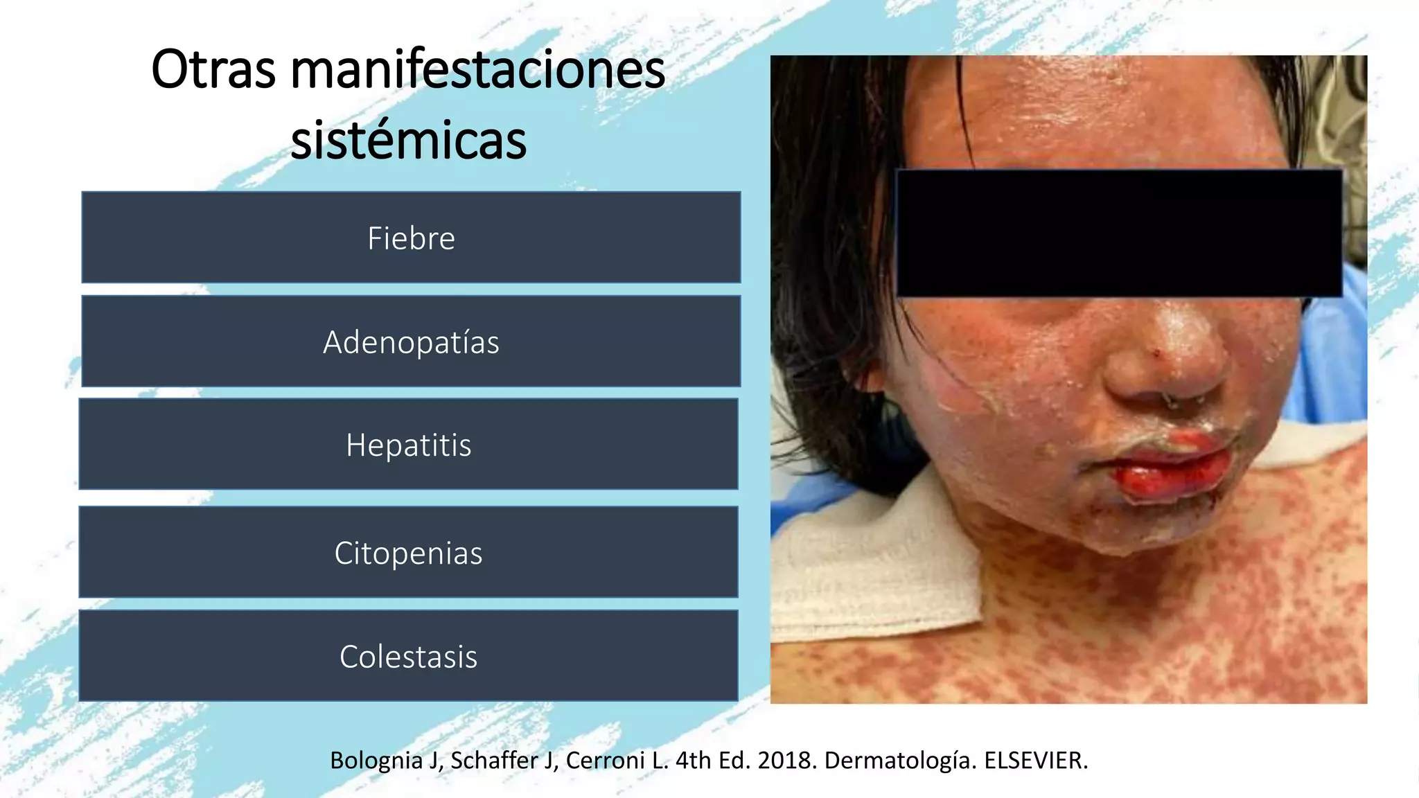 Síndrome de Stevens-Jonhson y Necrólisis Epidérmica Tóxica (NET) | PPTX ...