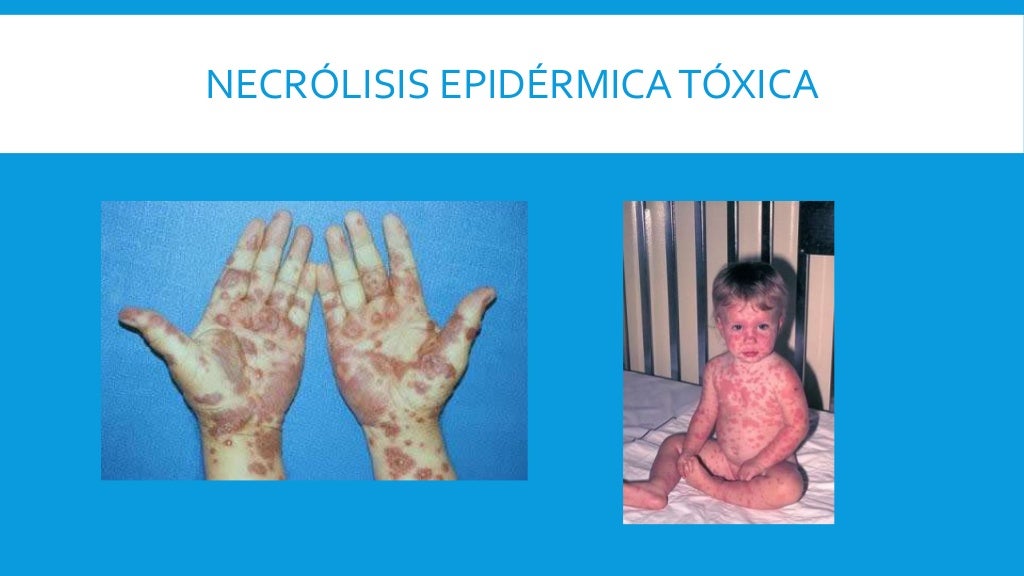 Síndrome de Stevens Johnson