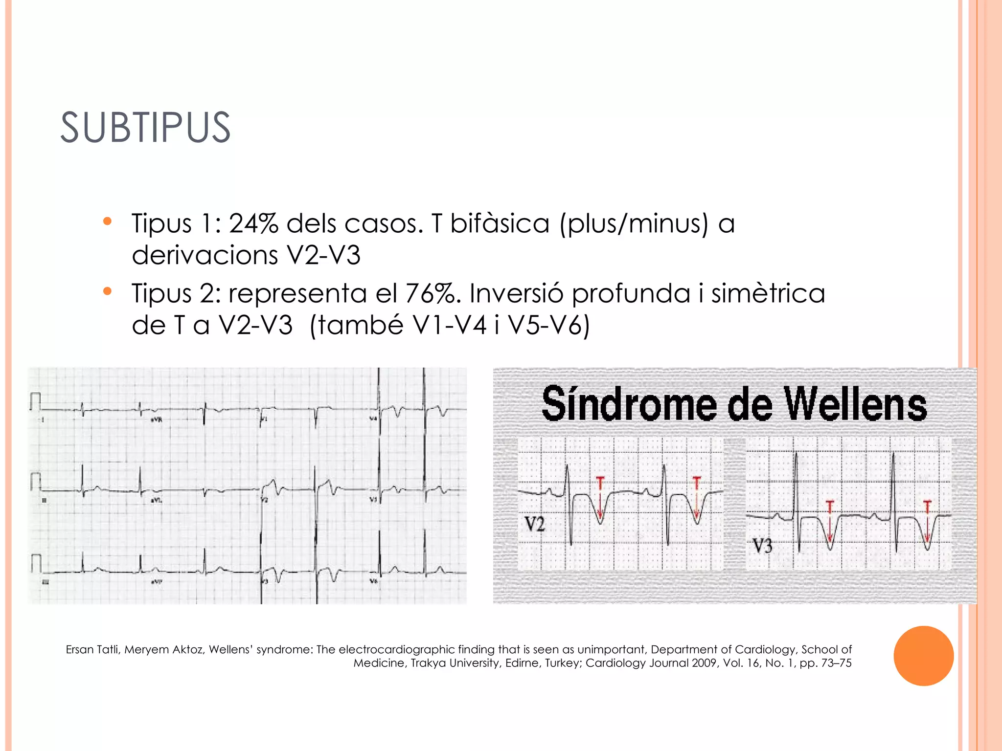 Síndrome de Wellens | PPT