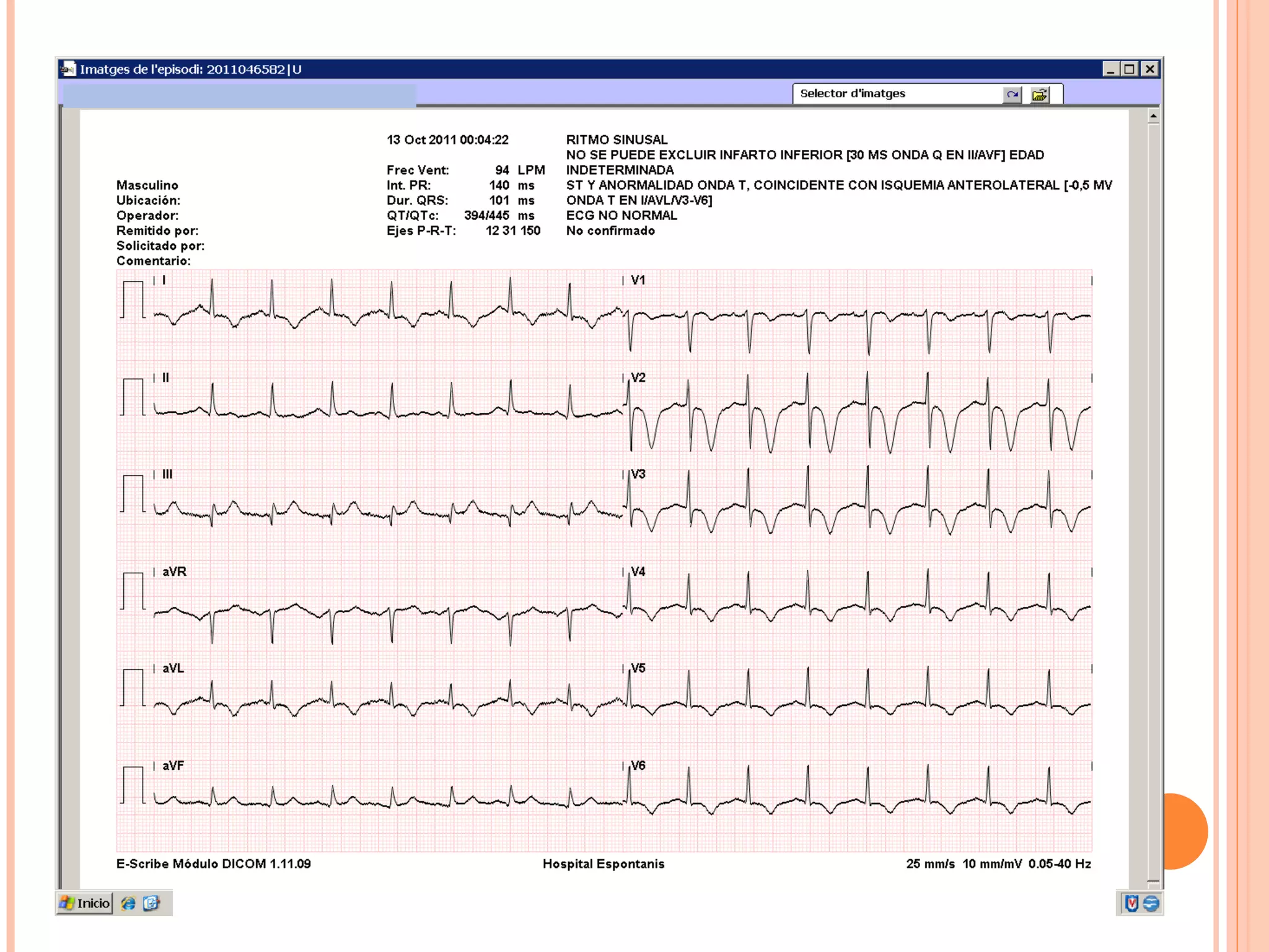Síndrome de Wellens | PPT