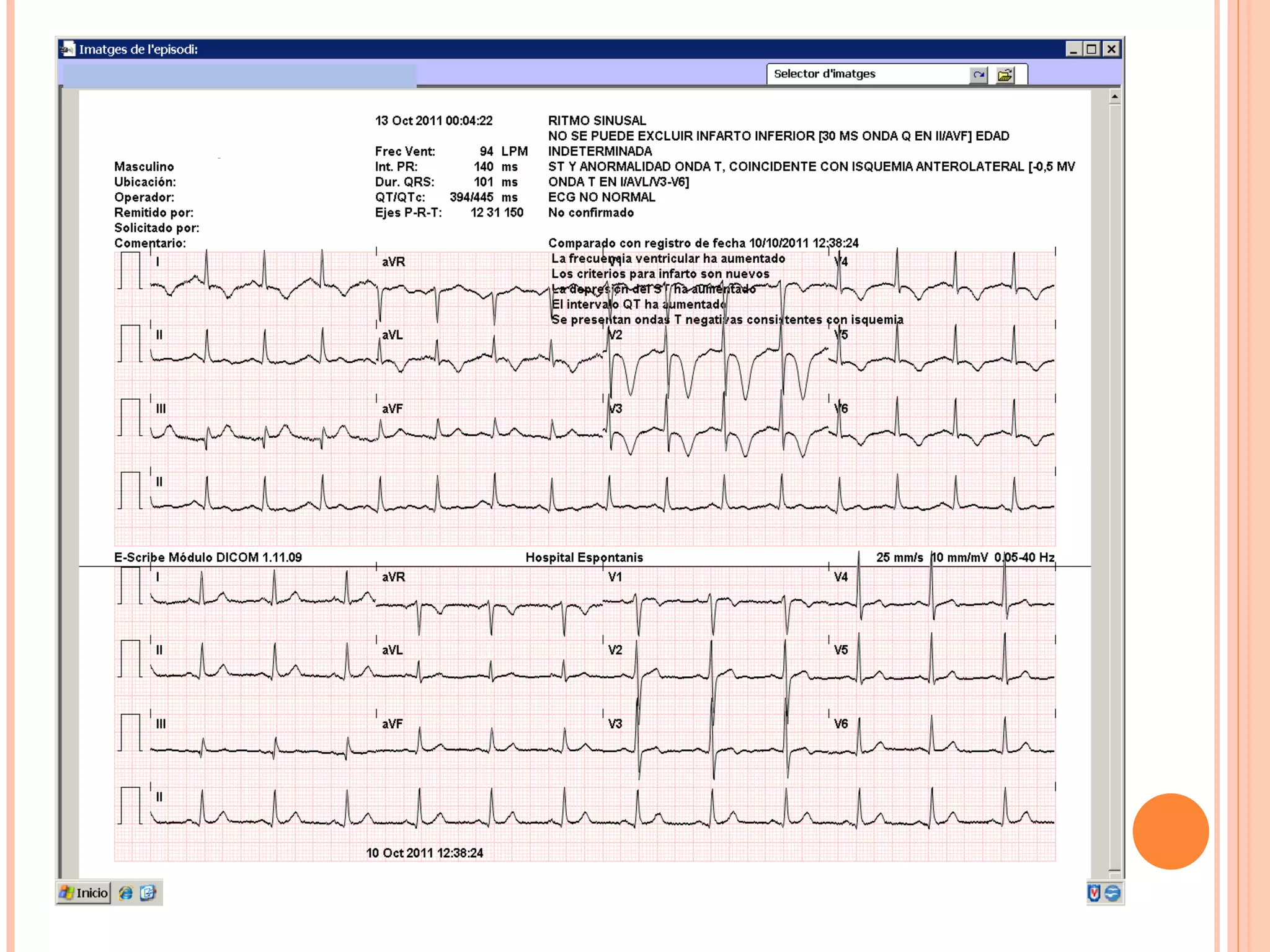 Síndrome de Wellens | PPT