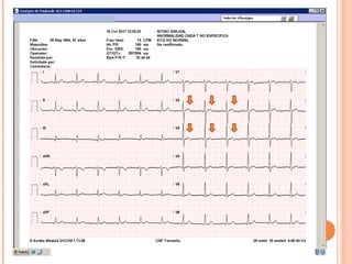 Síndrome de Wellens | PPT