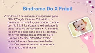 Síndrome do X Frágil.pptx