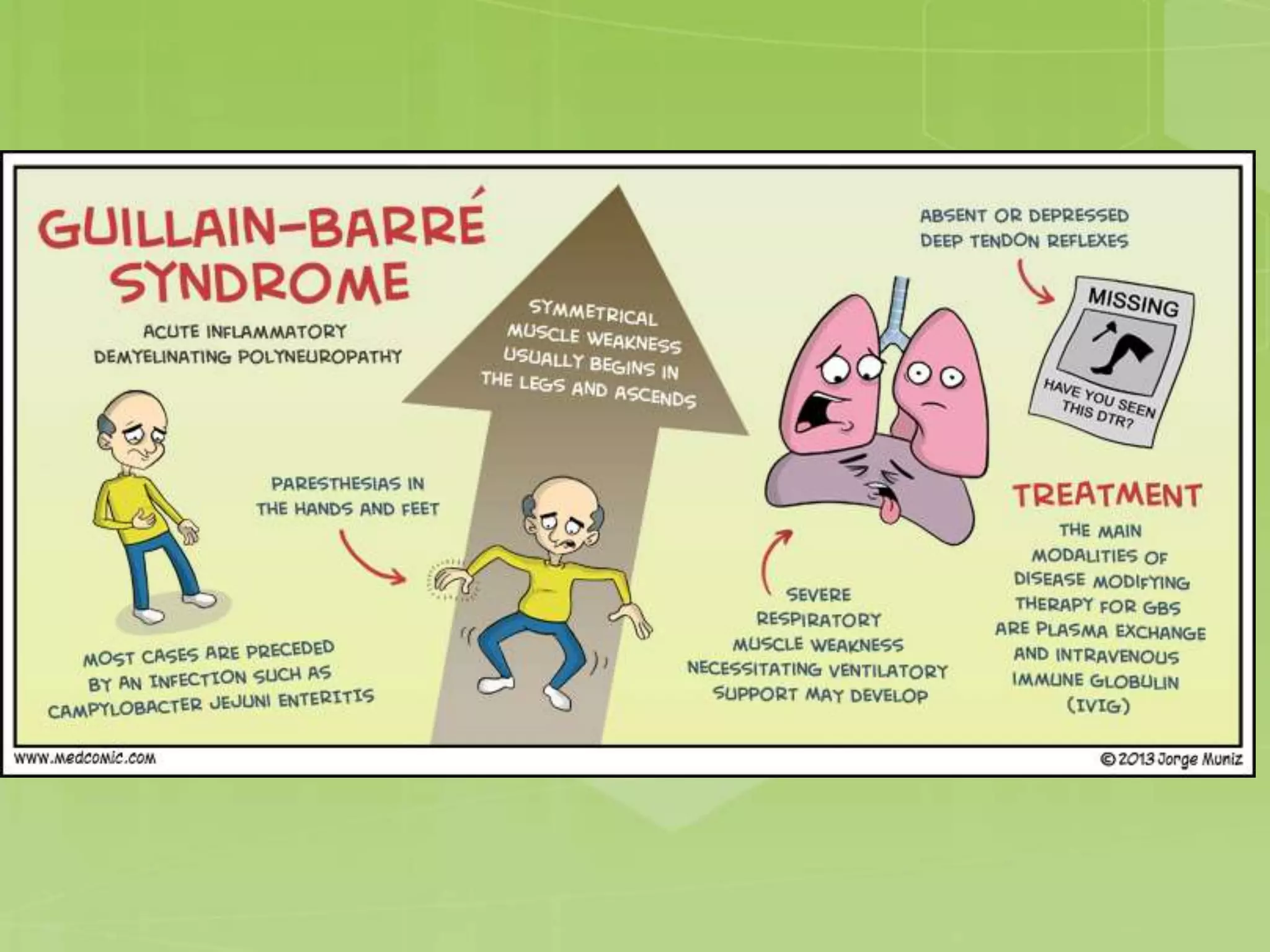 Síndrome guillain barré | PPT