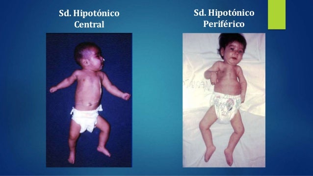 Síndrome hipotónico