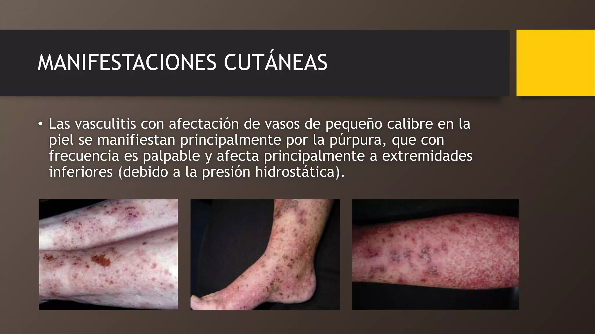 Síndromes de las vasculitis | PPTX