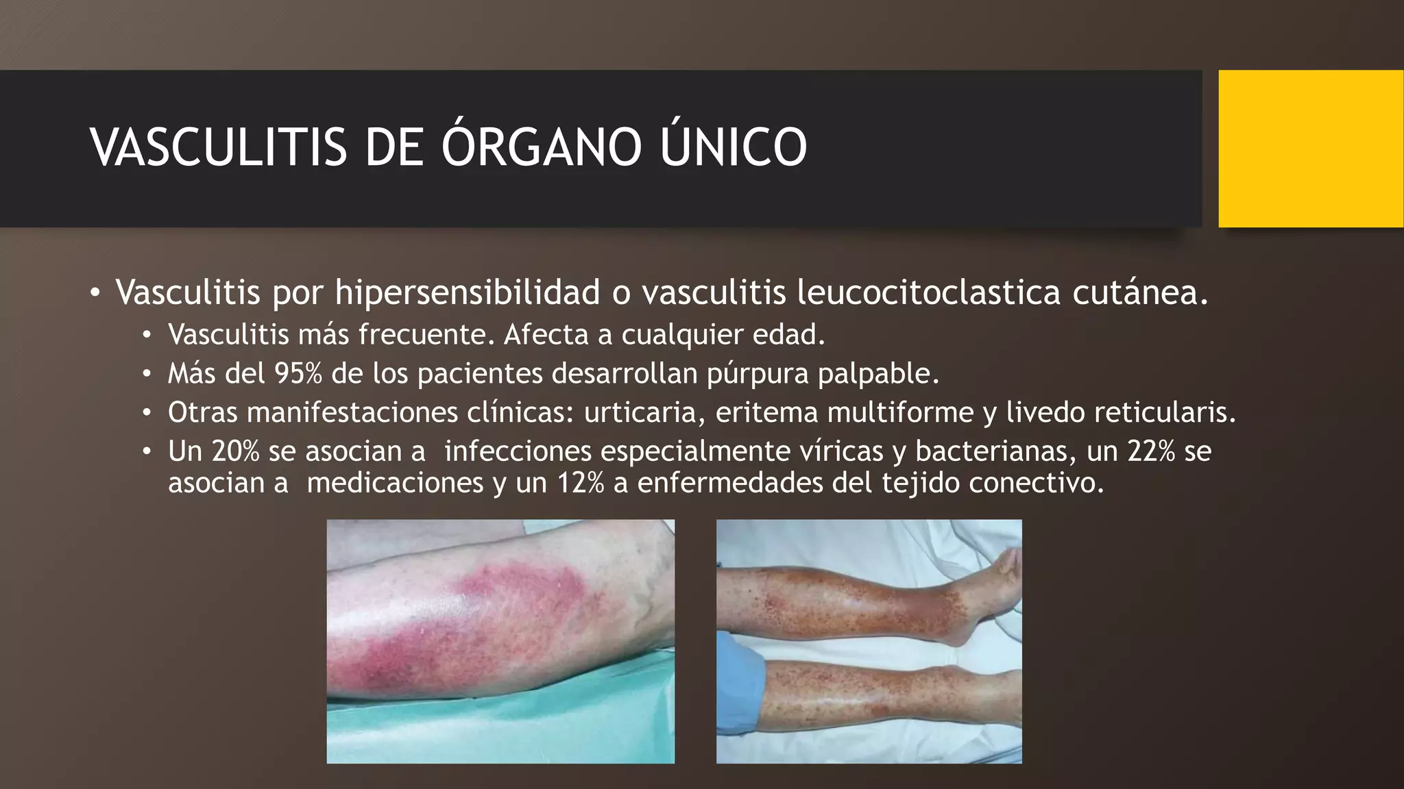 Síndromes de las vasculitis | PPT | Descarga Gratuita