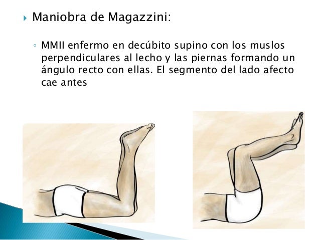 Síndromes medulares.