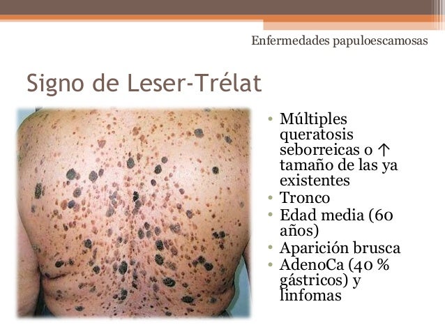 Síndromes paraneoplásicos cutáneos