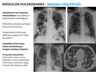 Síndromes pleurales y tumores pulmonares - Negrete Gómez Martha Paulina.pdf
