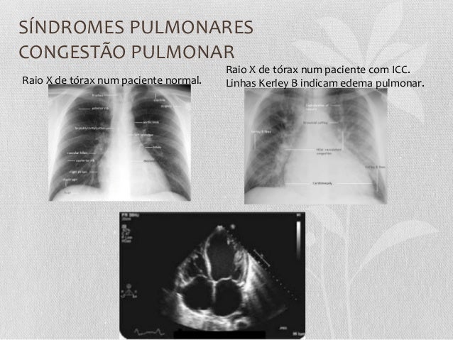 Síndromes pulmonares