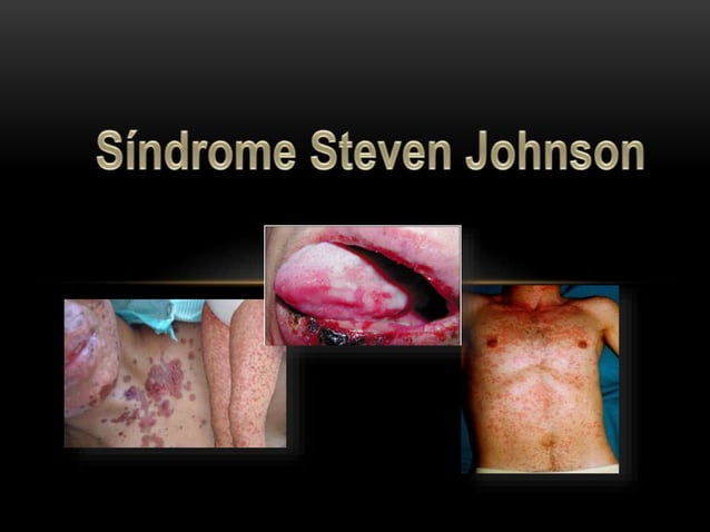 Síndrome steven johnson