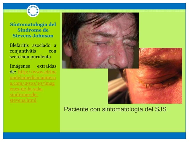 Síndrome Stevens Johnson y Necrólisis Epidérmica Tóxica UP Med | PPTX ...