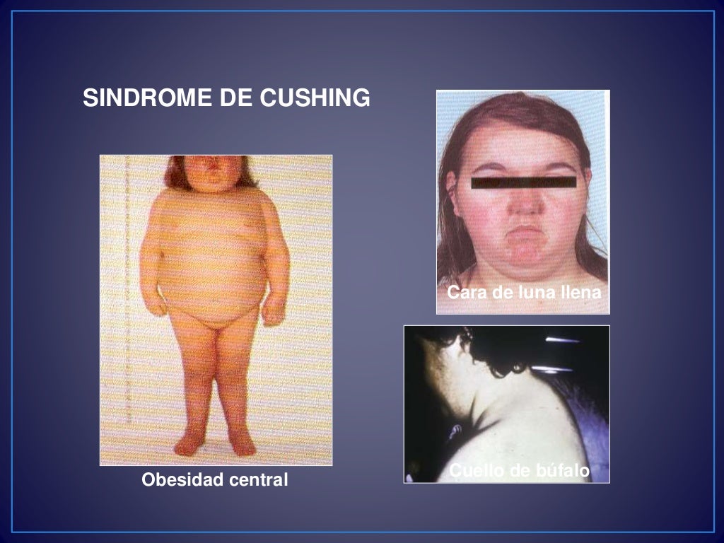 Síndrome y enfermedad de cushing