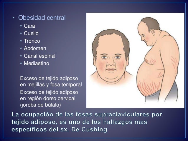 Síndrome y enfermedad de cushing