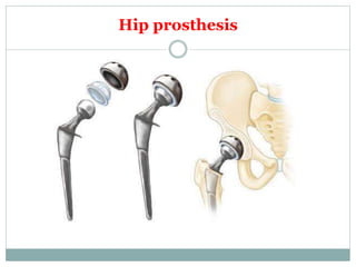 Prosthetic Body Parts | PPT