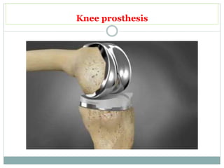 Prosthetic Body Parts | PPT