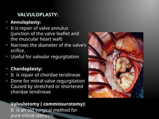 VALVE Disease and its nursing management | PPTX
