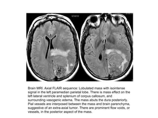 Harbor UCLA Neuro-Radiology — Case 4 | PPT