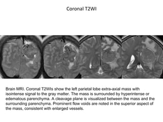 Harbor UCLA Neuro-Radiology — Case 4 | PPT