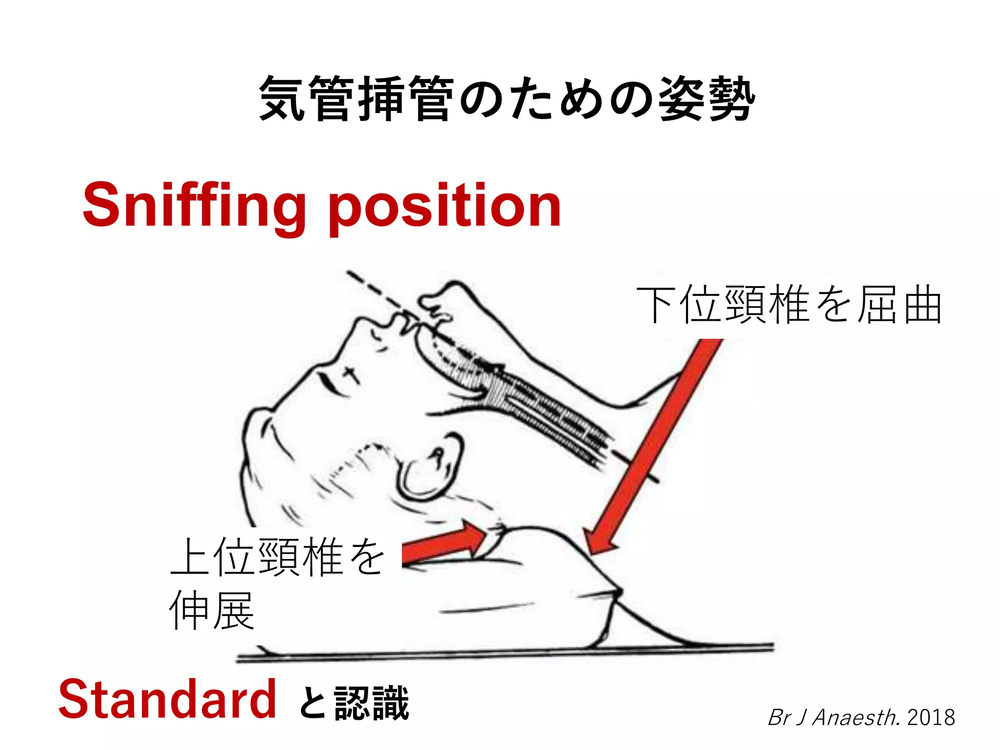 Sniff vs Ramp position for Tracheal intubation | PPTX