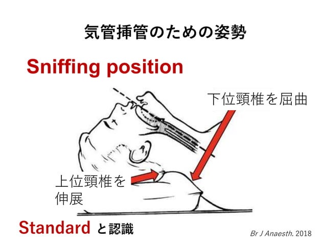 Sniff vs Ramp position for Tracheal intubation | PPTX | Lung and ...