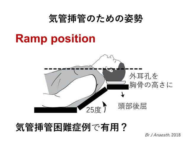 Sniff vs Ramp position for Tracheal intubation