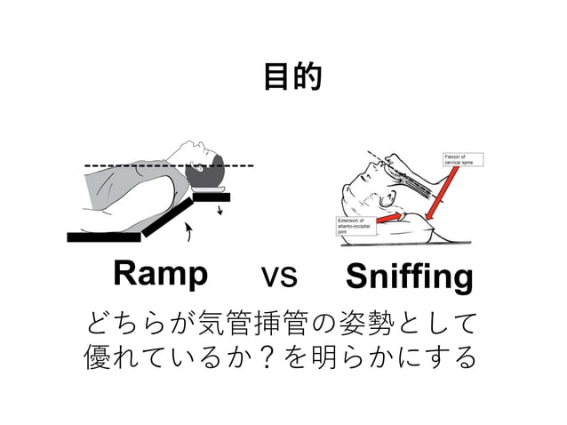 Sniff vs Ramp position for Tracheal intubation