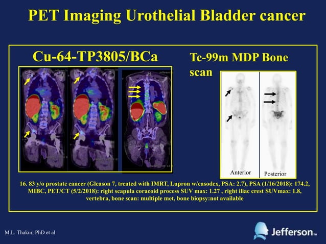 PET Imaging of Urothelial Bladder Cancer | PPT
