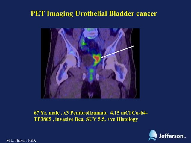 PET Imaging of Urothelial Bladder Cancer | PPTX