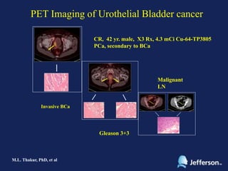 PET Imaging of Urothelial Bladder Cancer | PPTX