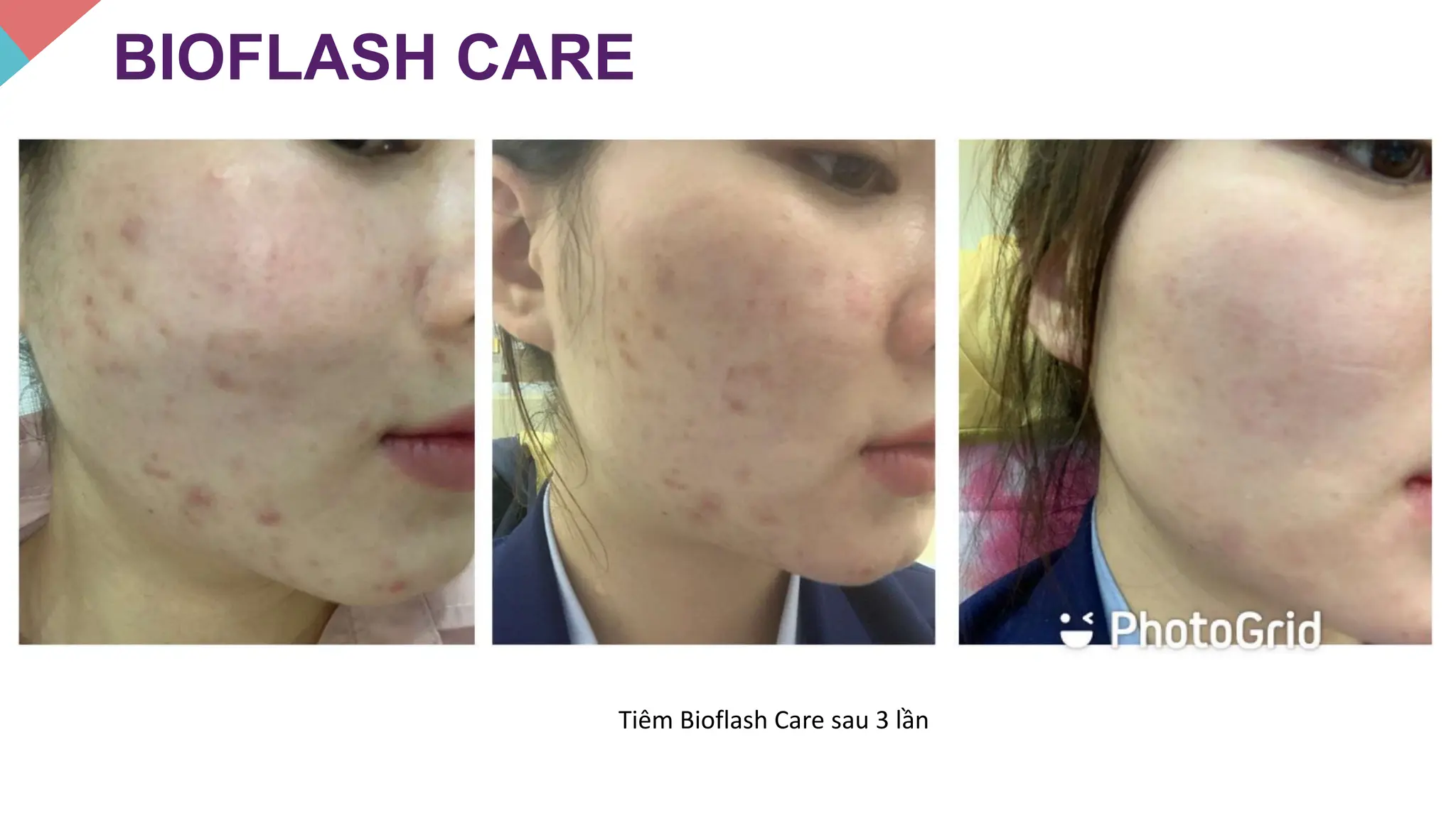 Sản phẩm tiêm Meso từ thương hiệu Skinclinic | PPTX