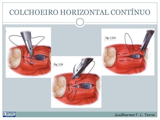 Síntese e técnicas sutura 2013